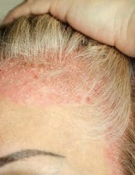 Démangeaison cuir chevelu, eczéma, psoriasis📍 Solutions efficaces