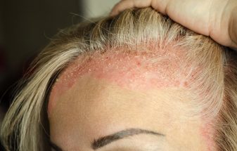 Démangeaison cuir chevelu, eczéma, psoriasis📍 Solutions efficaces
